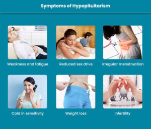 Hypopituitarism: Causes, Symptoms, Diagnosis, and Treatment