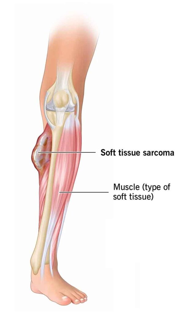 What is Soft Tissue Sarcoma? | Specialty Care Clinics