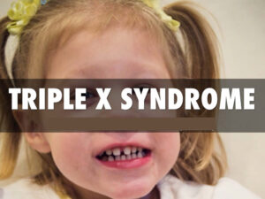 Triple X Syndrome - Symptoms, Causes, and Treatment