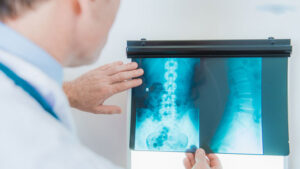 What is Retrolisthesis? What are its Symptoms, Causes and Treatment?